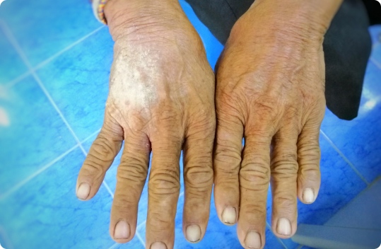 Scleroderma Specialist | Sherman Rheumatologist Care